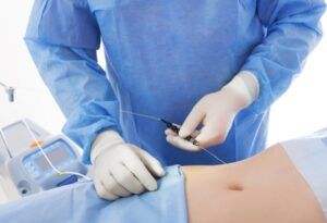 ᐈ ¿Cuánto sale una Liposucción en Argentina? Precios mayo 2026